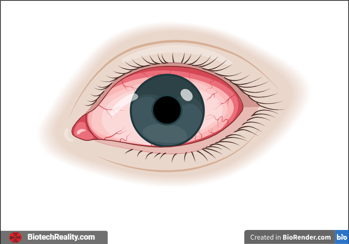 Conjunctivitis - Cause, Diagnosis, and Treatment