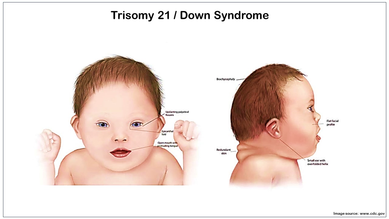 Epicanthal Folds Down Syndrome Symptoms And Characteristics Of Down